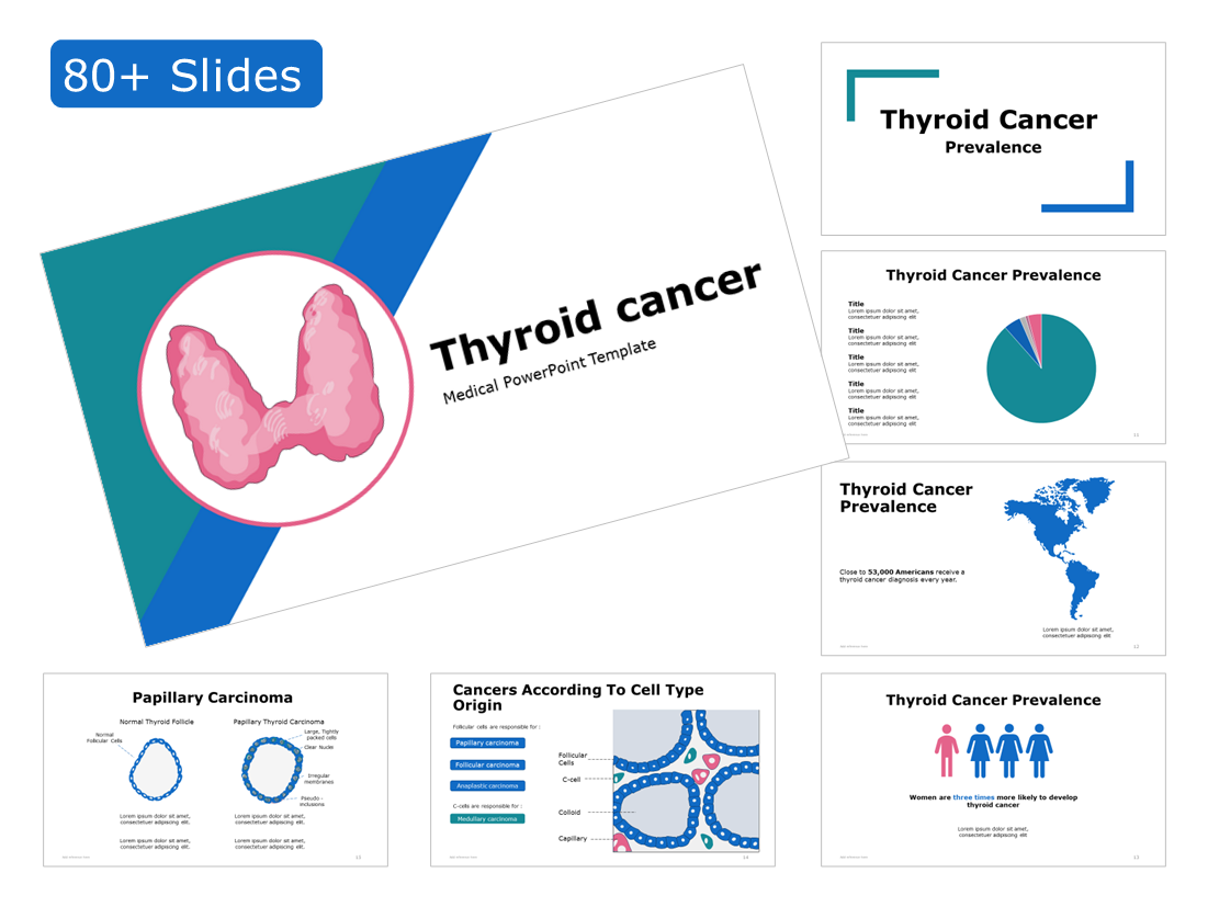 Thyroid Cancer PowerPoint Template - RxSlides - The largest online store for medical PowerPoint ...